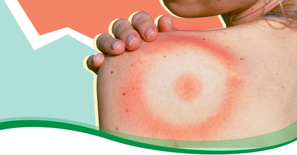 Lyme-kór: miért kezelik félre sokszor? | Medibon
